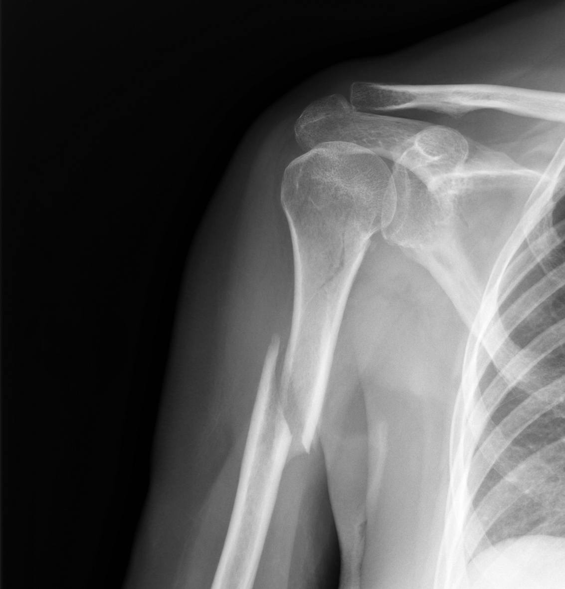 Humerus Fracture in a Car Accident: How Does it Happen?