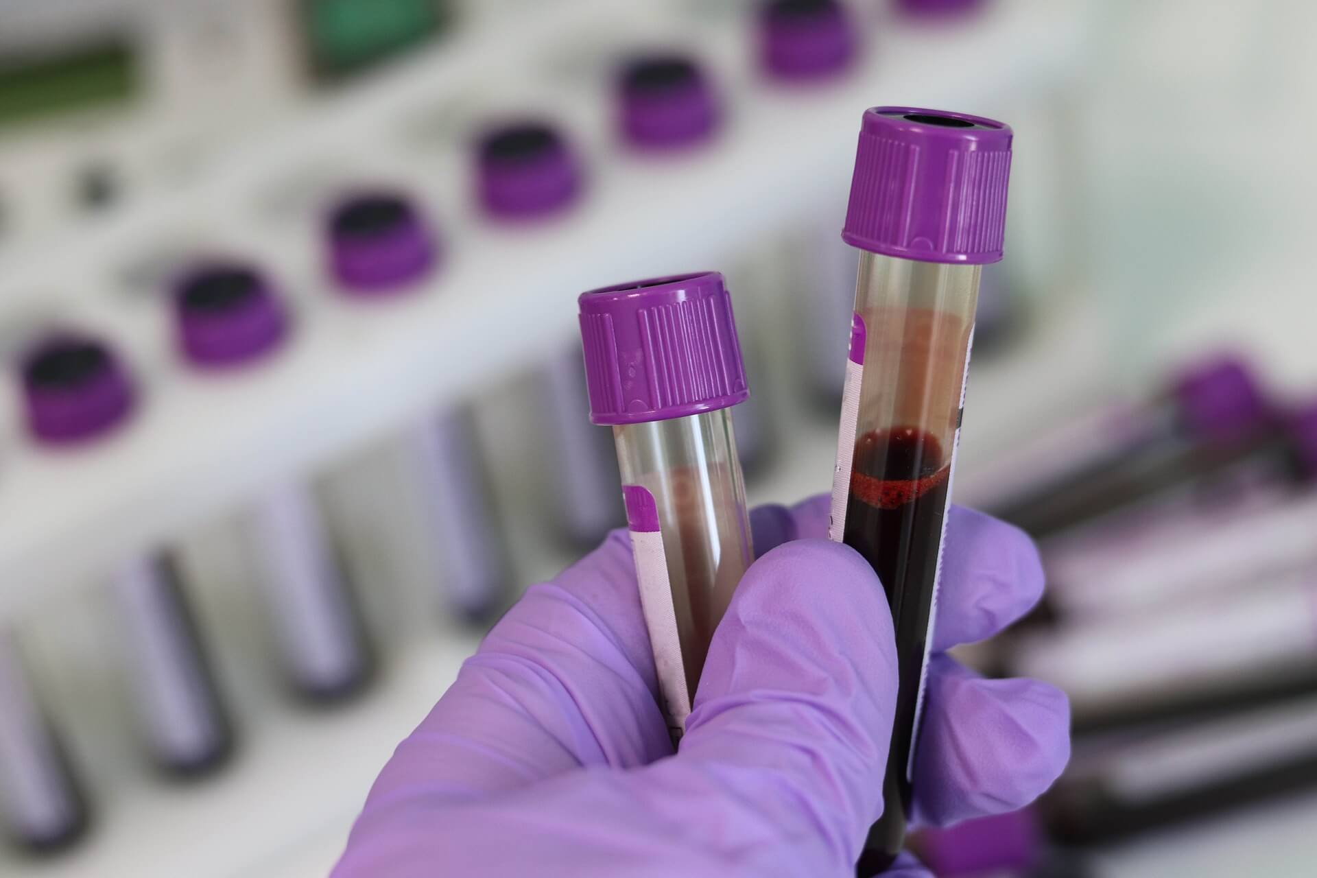Brain Injury Blood Test Explored in Recently Published Study