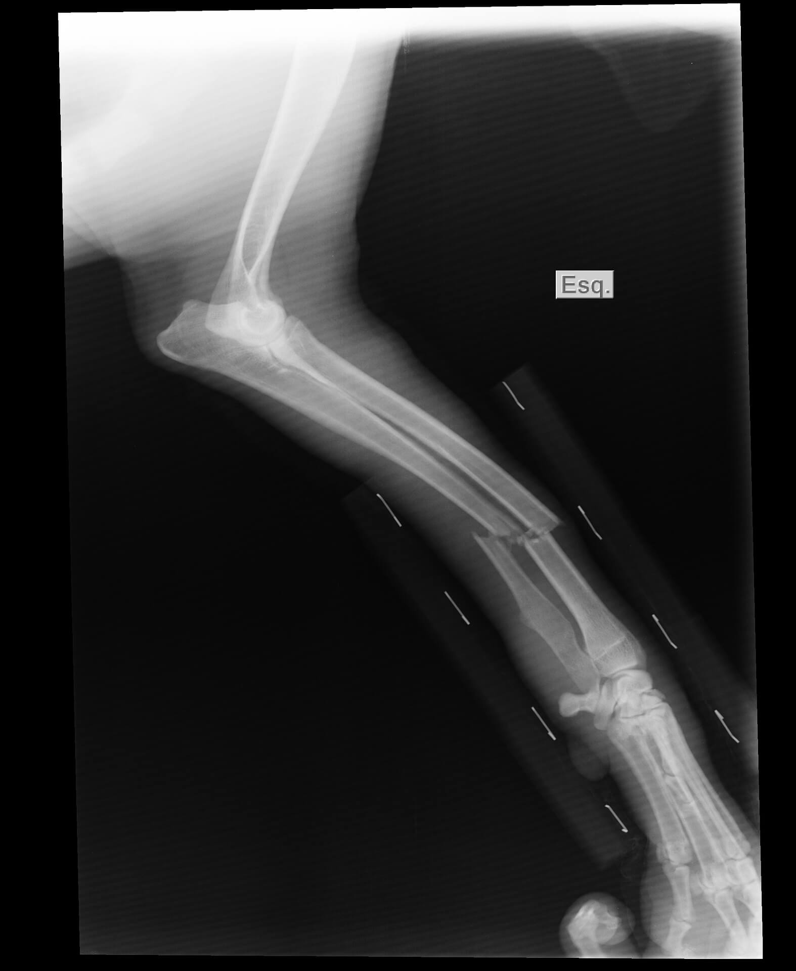 Essex-Lopresti Fracture Dislocation: An Overview of a Serious Arm Injury