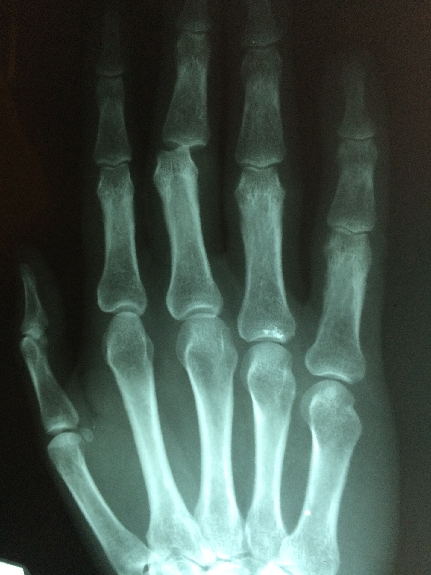 Torus Fracture: An Overview of the Diagnosis and Treatment